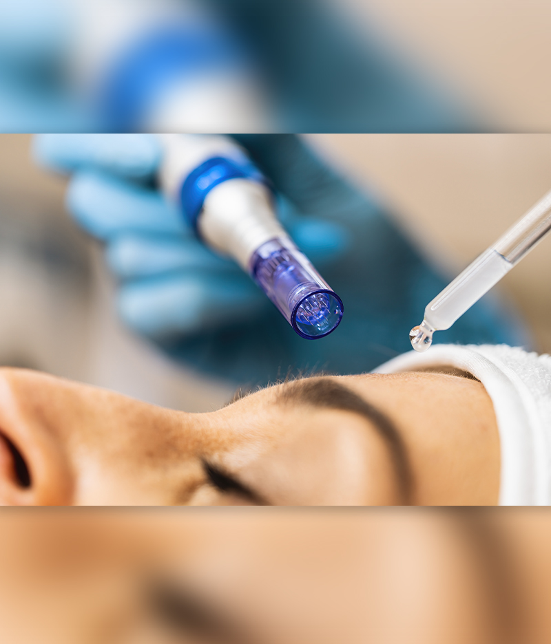 Best Aesthetic Clinic in Kozhikode | Microneedling in Calicut